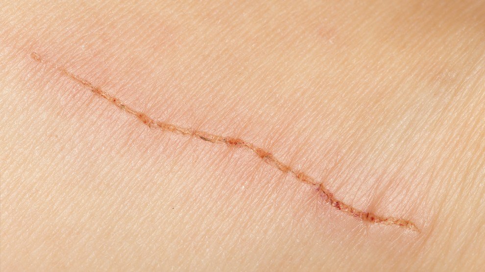 Estudian genética de células que determinan proceso de cicatrización